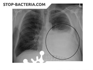 Tuberculous Pleurisy – Healthy Life and Antibiotics Blog
